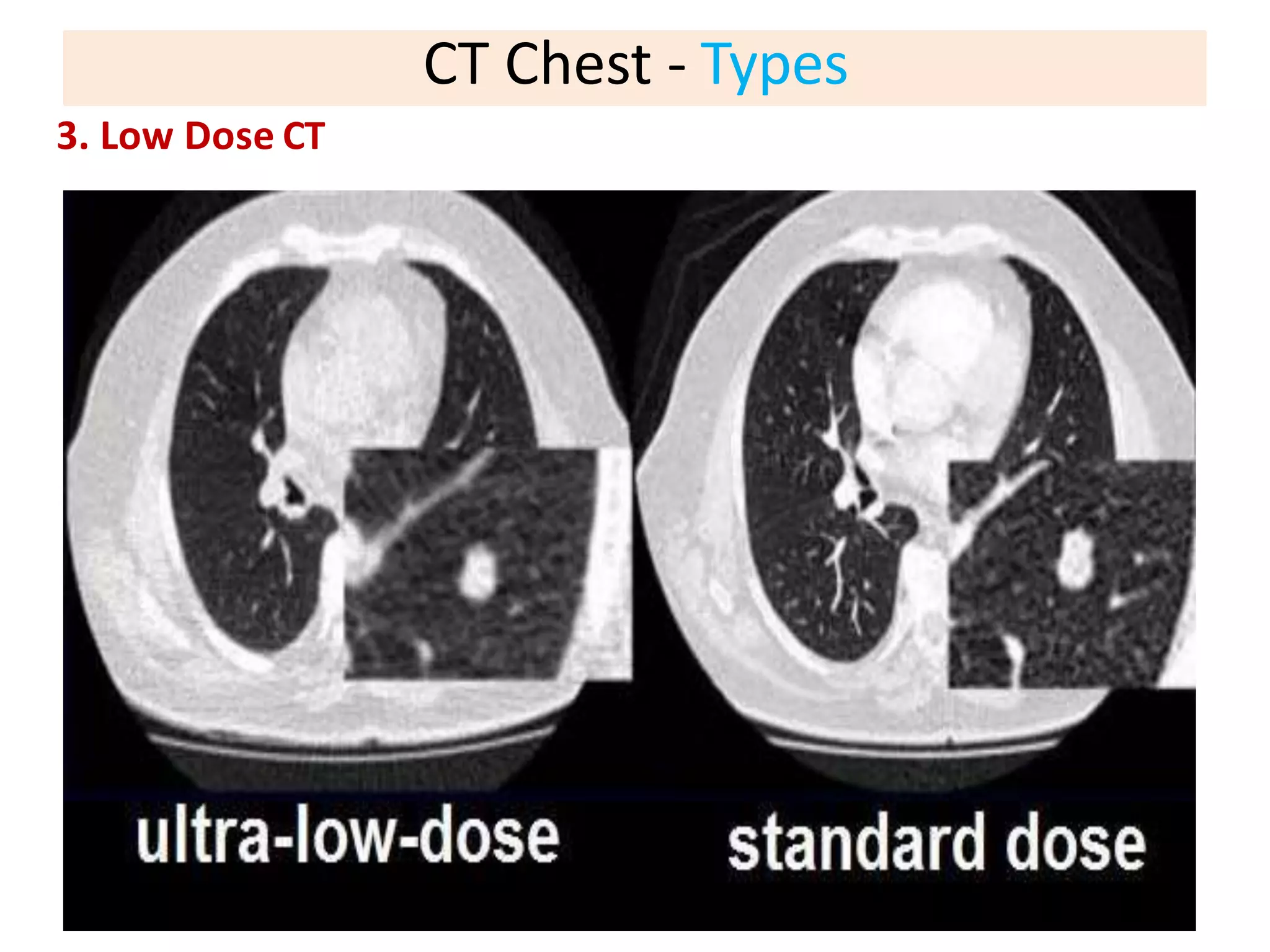 Basics of CT chest | PPTX | Lung and Respiratory Health | Diseases and ...