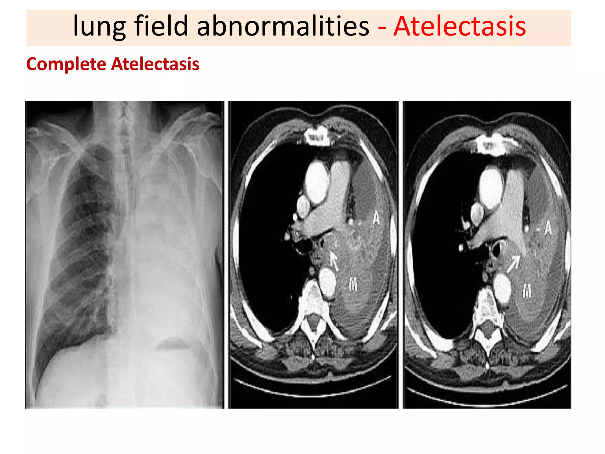 Basics of CT chest | PPTX