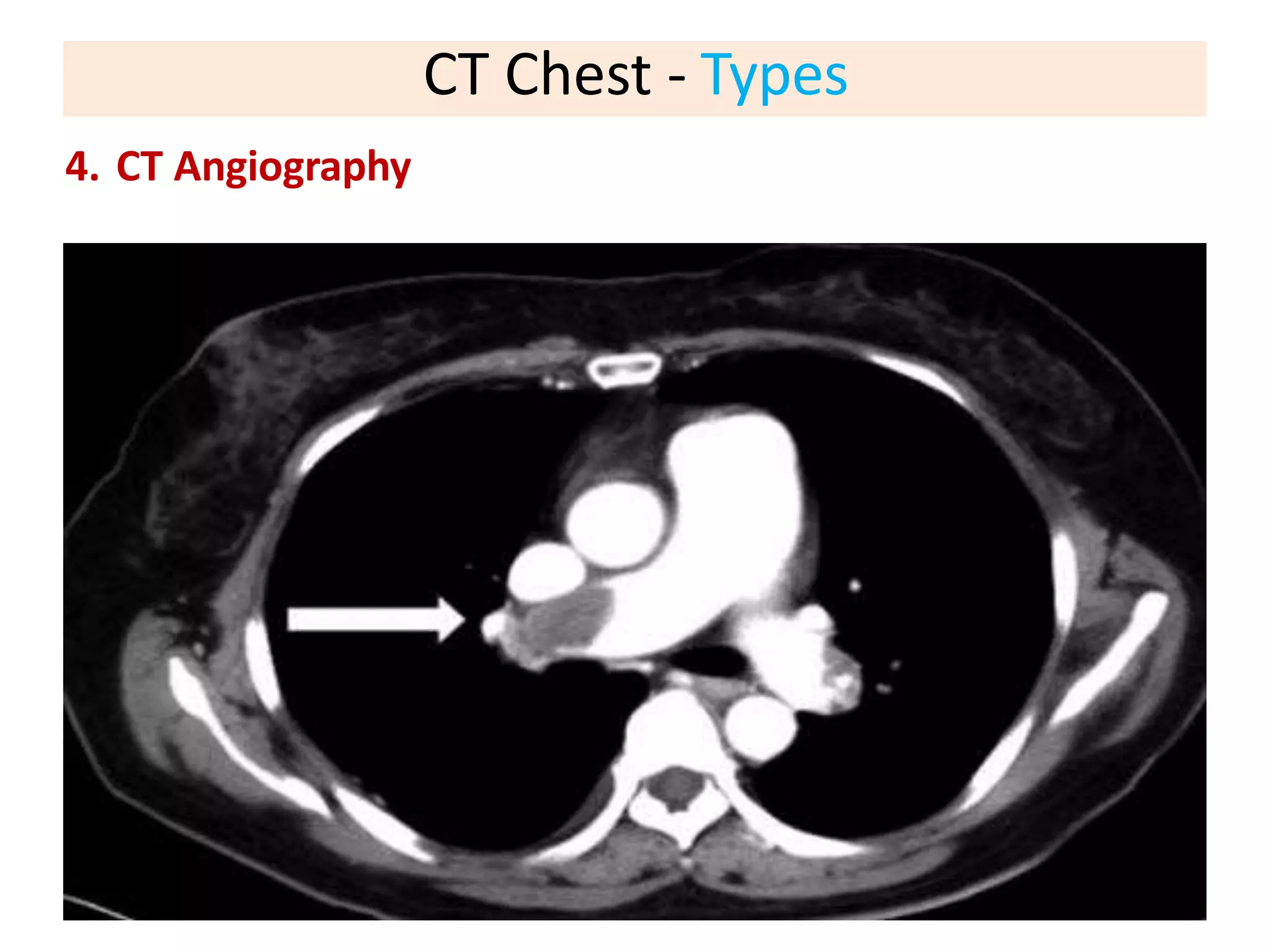 Basics of CT chest | PPTX | Lung and Respiratory Health | Diseases and ...