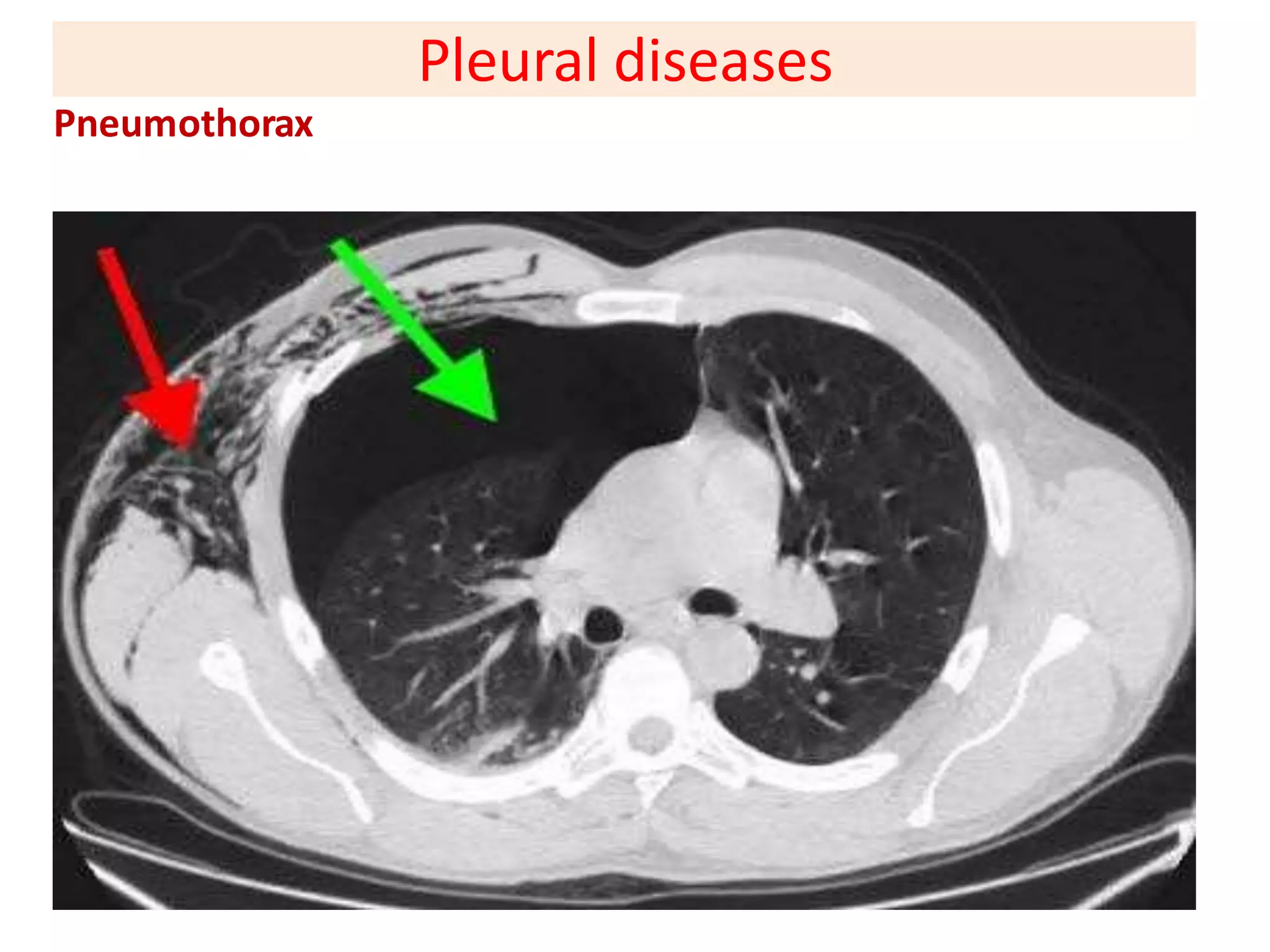 Basics of CT chest | PPTX