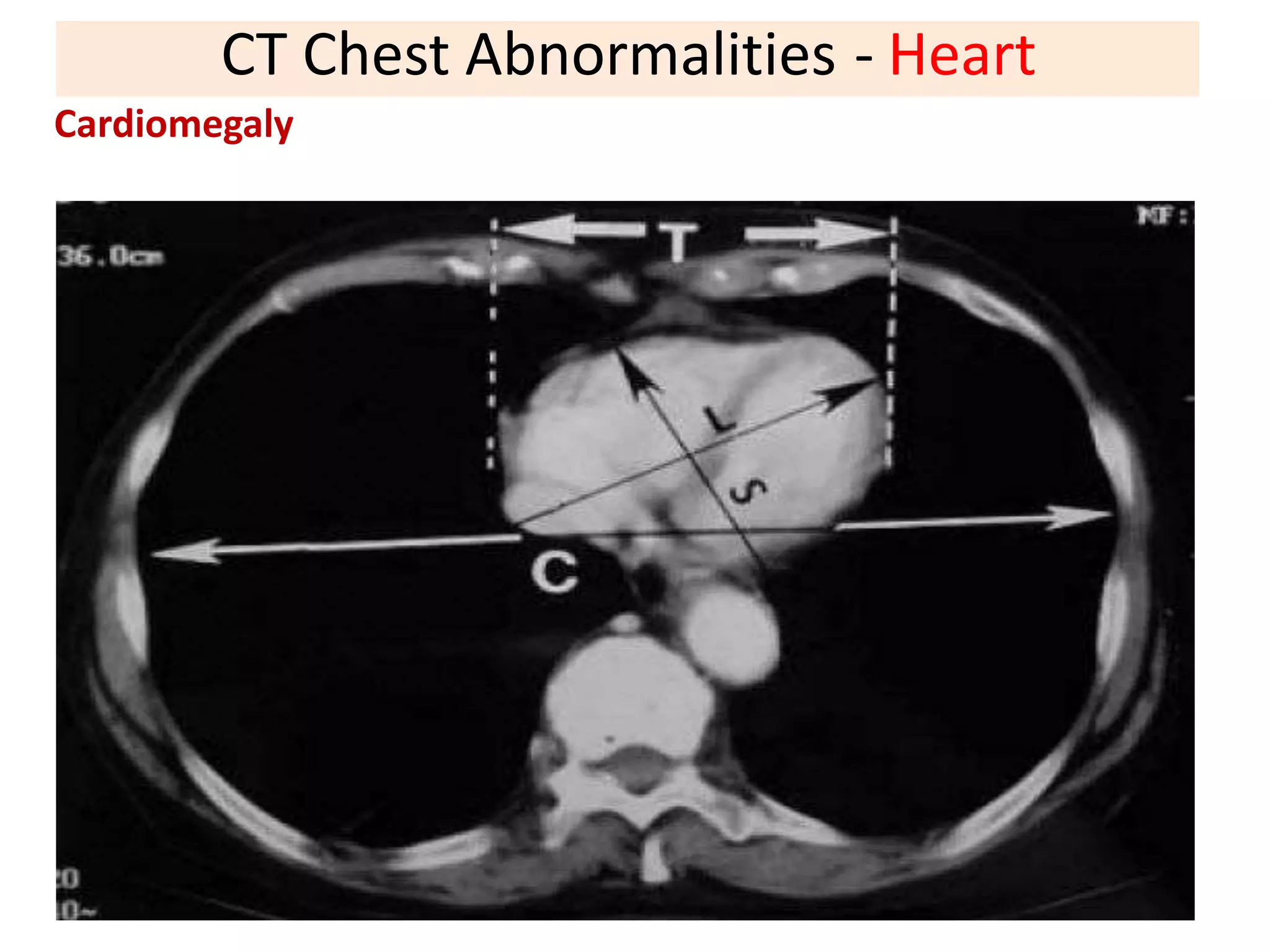 Basics of CT chest | PPTX