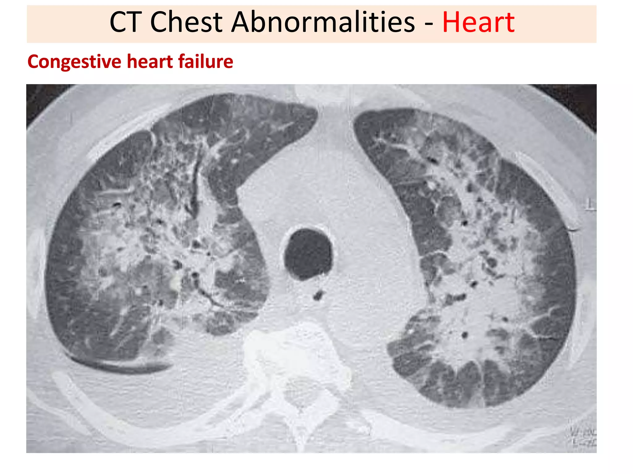 Basics of CT chest | PPTX