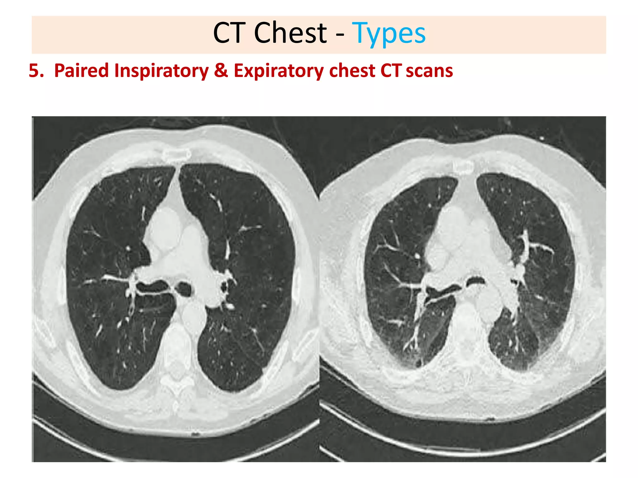 Basics of CT chest | PPTX