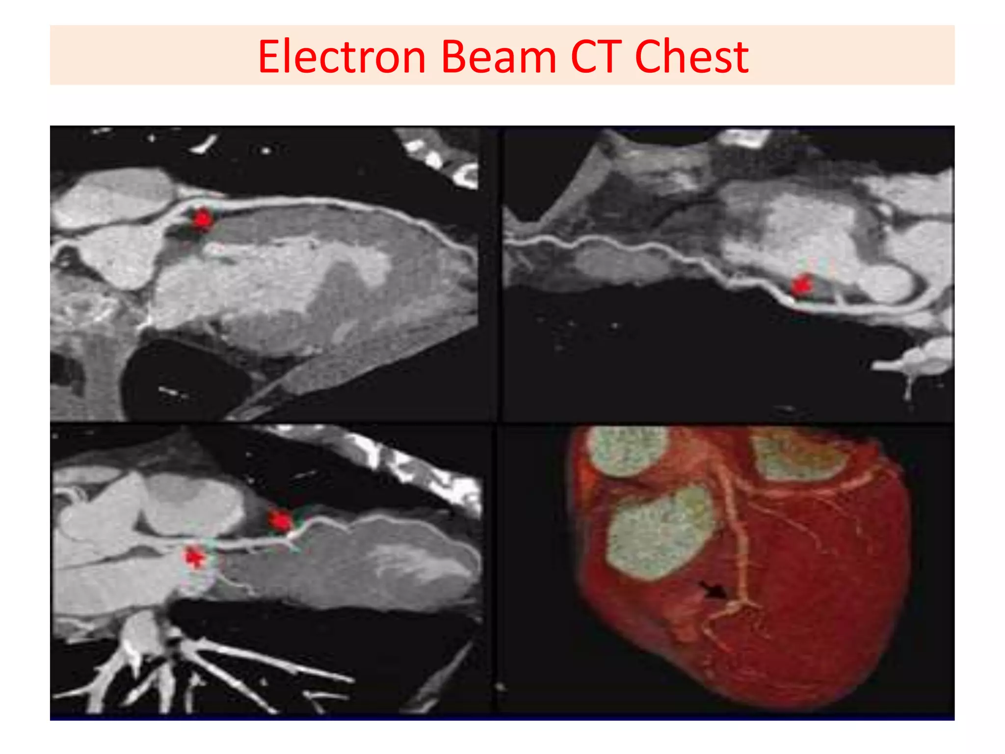 Basics of CT chest | PPTX