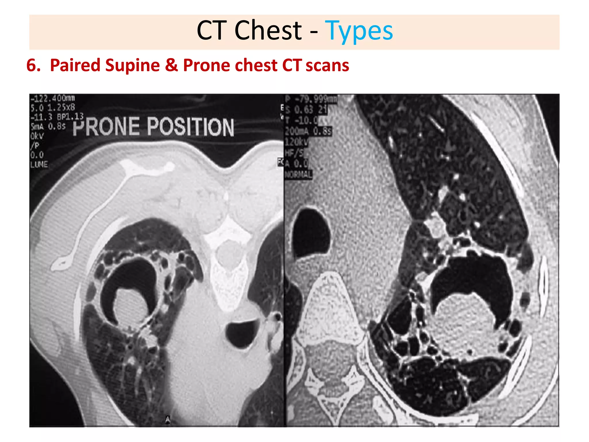 Basics of CT chest | PPTX