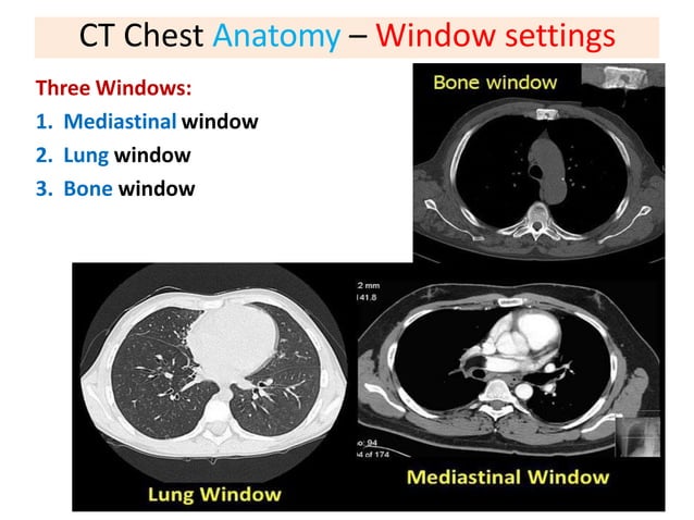 Basics of CT chest | PPTX | Lung and Respiratory Health | Diseases and ...