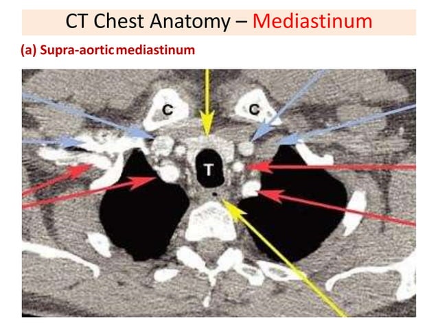 Basics of CT chest | PPTX | Lung and Respiratory Health | Diseases and ...