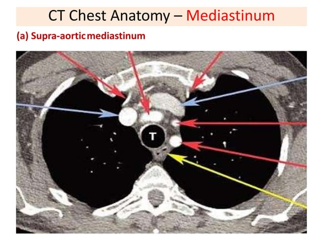 Basics of CT chest | PPTX | Lung and Respiratory Health | Diseases and ...
