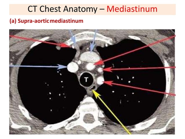Basics of CT chest | PPTX | Lung and Respiratory Health | Diseases and ...