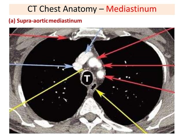 Basics of CT chest | PPTX | Lung and Respiratory Health | Diseases and ...
