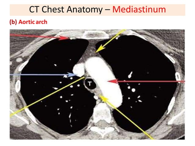 Basics of CT chest | PPTX | Lung and Respiratory Health | Diseases and ...