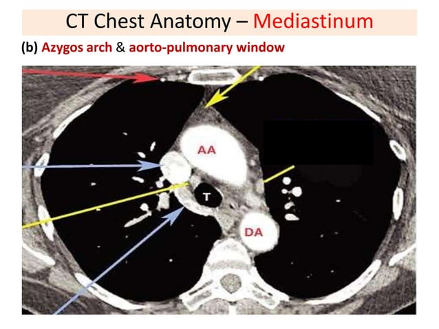 Basics of CT chest | PPTX | Lung and Respiratory Health | Diseases and ...