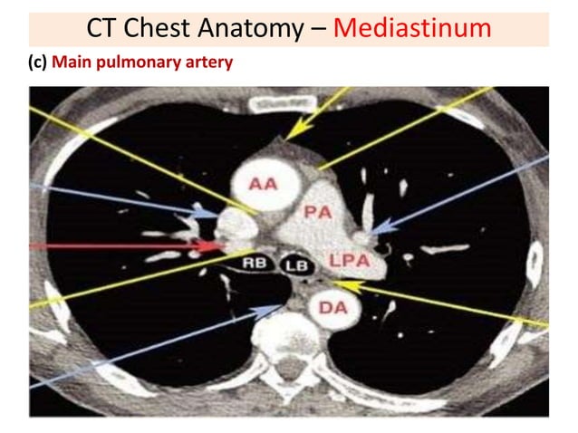 Basics of CT chest | PPTX | Lung and Respiratory Health | Diseases and ...
