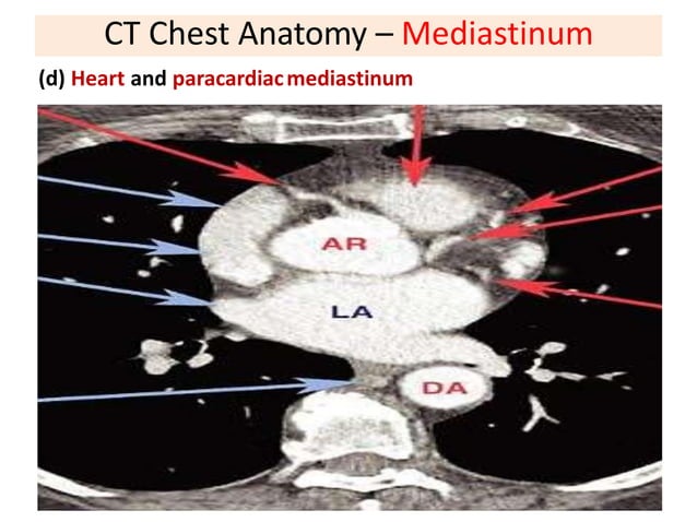 Basics of CT chest | PPTX | Lung and Respiratory Health | Diseases and ...