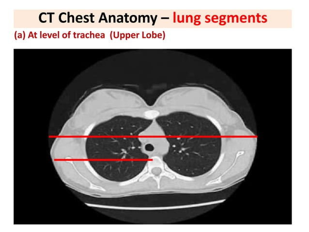 Basics of CT chest | PPTX | Lung and Respiratory Health | Diseases and ...