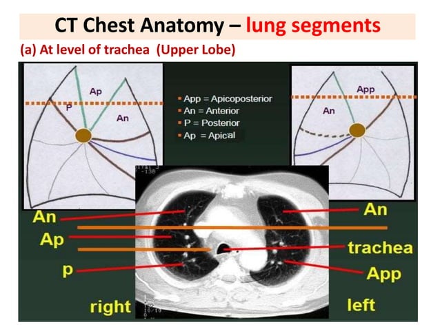 Basics of CT chest | PPTX | Lung and Respiratory Health | Diseases and ...