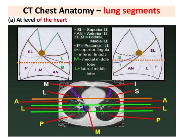 Basics of CT chest | PPTX | Lung and Respiratory Health | Diseases and ...