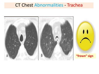 Basics of CT chest | PPTX