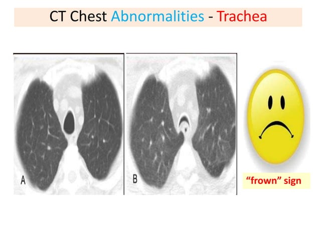 Basics of CT chest | PPTX | Lung and Respiratory Health | Diseases and ...