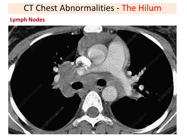 Basics of CT chest | PPTX | Lung and Respiratory Health | Diseases and ...