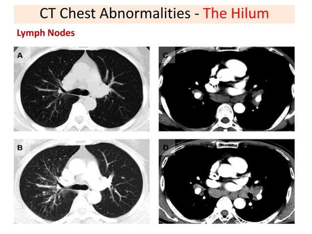 Basics of CT chest | PPTX | Lung and Respiratory Health | Diseases and ...