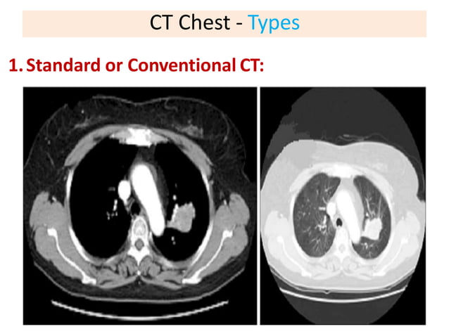 Basics of CT chest | PPTX | Lung and Respiratory Health | Diseases and ...