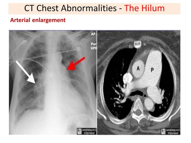 Basics of CT chest | PPTX | Lung and Respiratory Health | Diseases and ...
