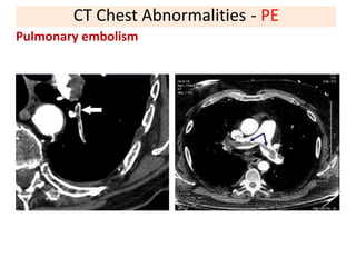 Basics of CT chest | PPTX