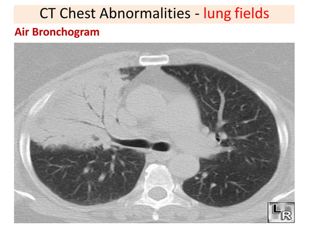 Basics of CT chest | PPTX | Lung and Respiratory Health | Diseases and ...