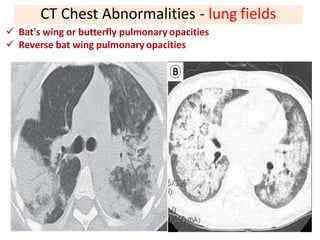 Basics of CT chest | PPTX