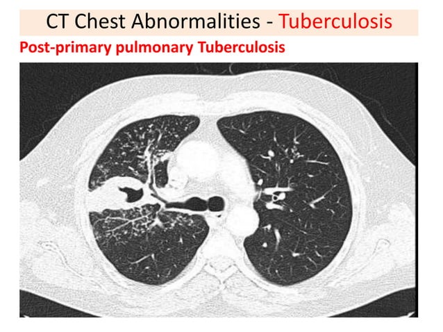 Basics of CT chest | PPTX | Lung and Respiratory Health | Diseases and ...