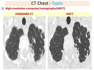 Basics of CT chest | PPTX