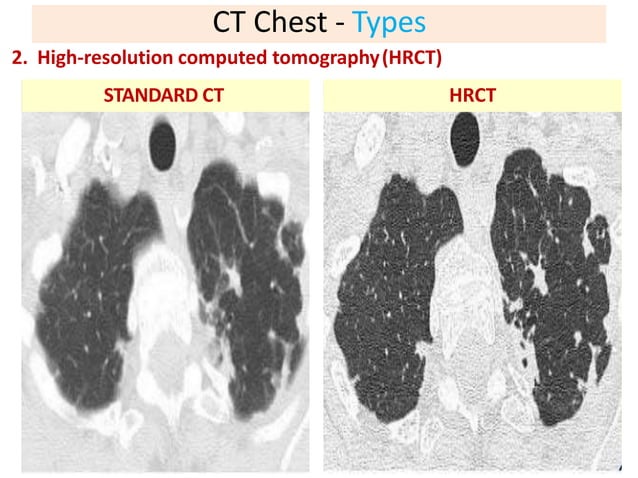 Basics of CT chest | PPTX | Lung and Respiratory Health | Diseases and ...