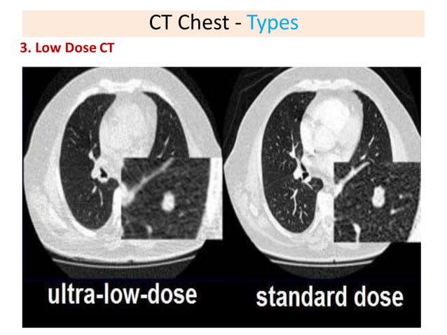 Basics of CT chest | PPTX | Lung and Respiratory Health | Diseases and ...