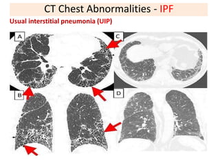 Basics of CT chest | PPTX