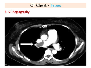 Basics of CT chest | PPTX