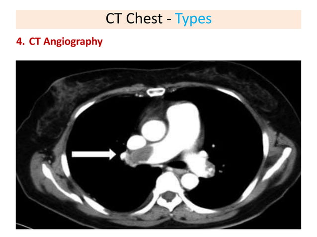 Basics of CT chest | PPTX | Lung and Respiratory Health | Diseases and ...