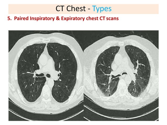 Basics of CT chest | PPTX | Lung and Respiratory Health | Diseases and ...