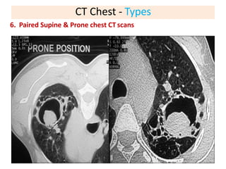 Basics of CT chest | PPTX