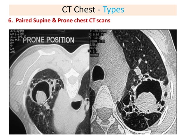 Basics of CT chest | PPTX | Lung and Respiratory Health | Diseases and ...