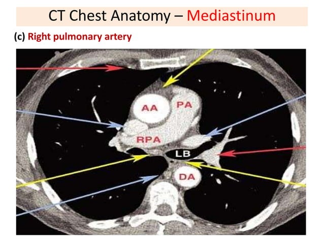Basics of CT chest | PPT