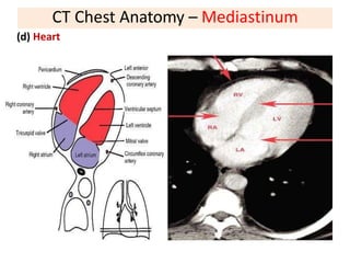 Heart Ct Scan Labeled