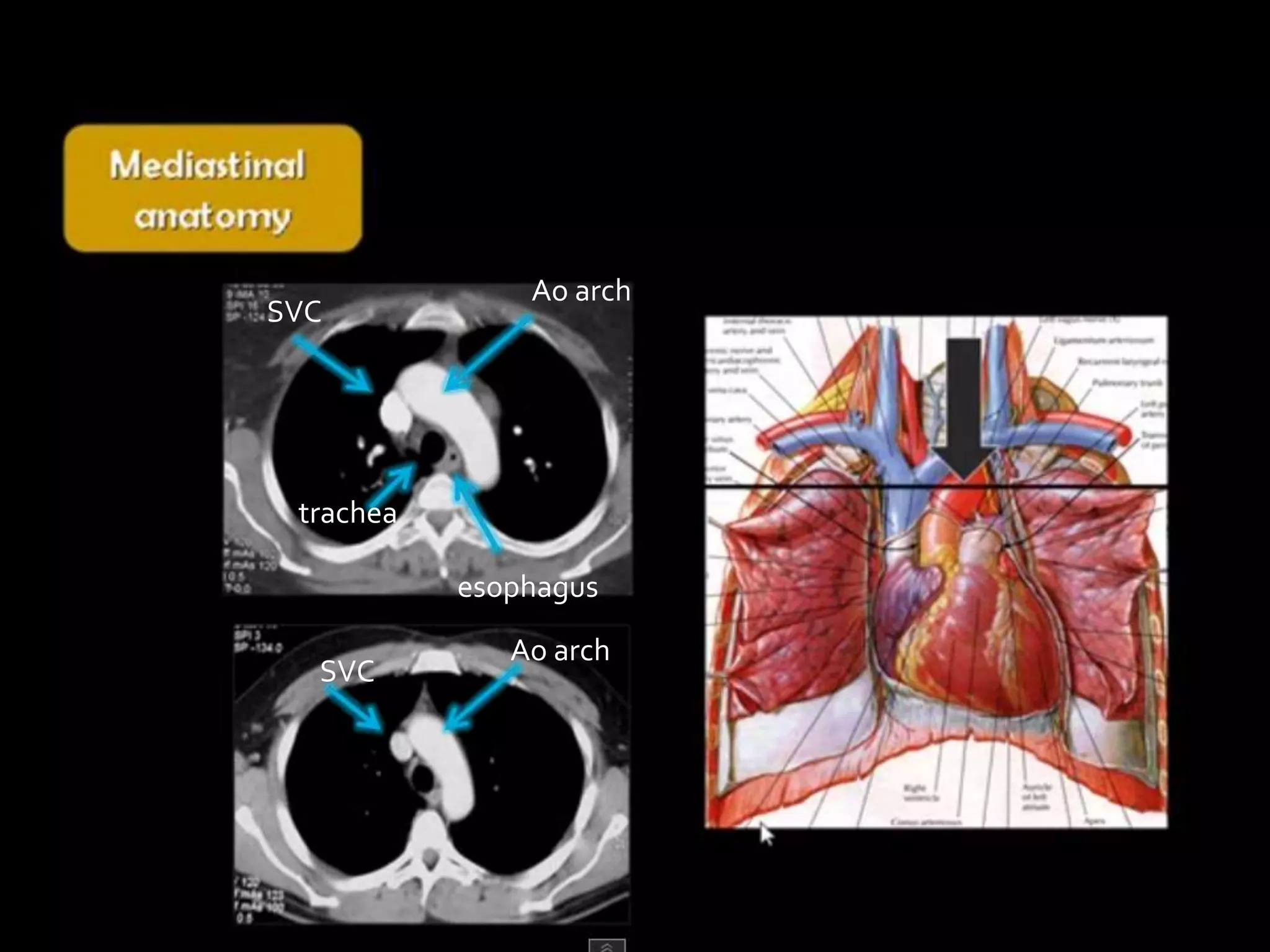 CT CHEST ANATOMY | PPTX