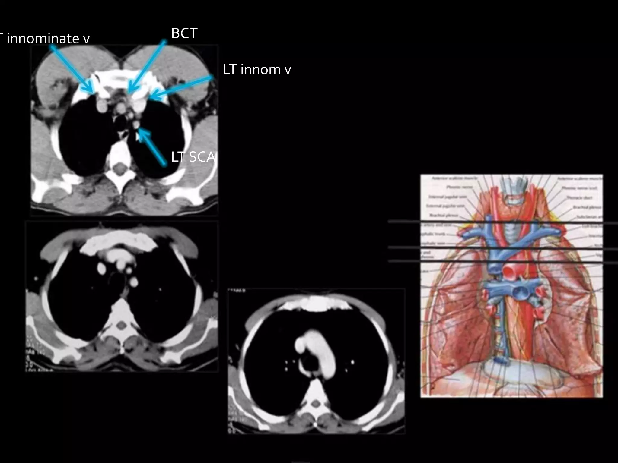 CT CHEST ANATOMY | PPTX