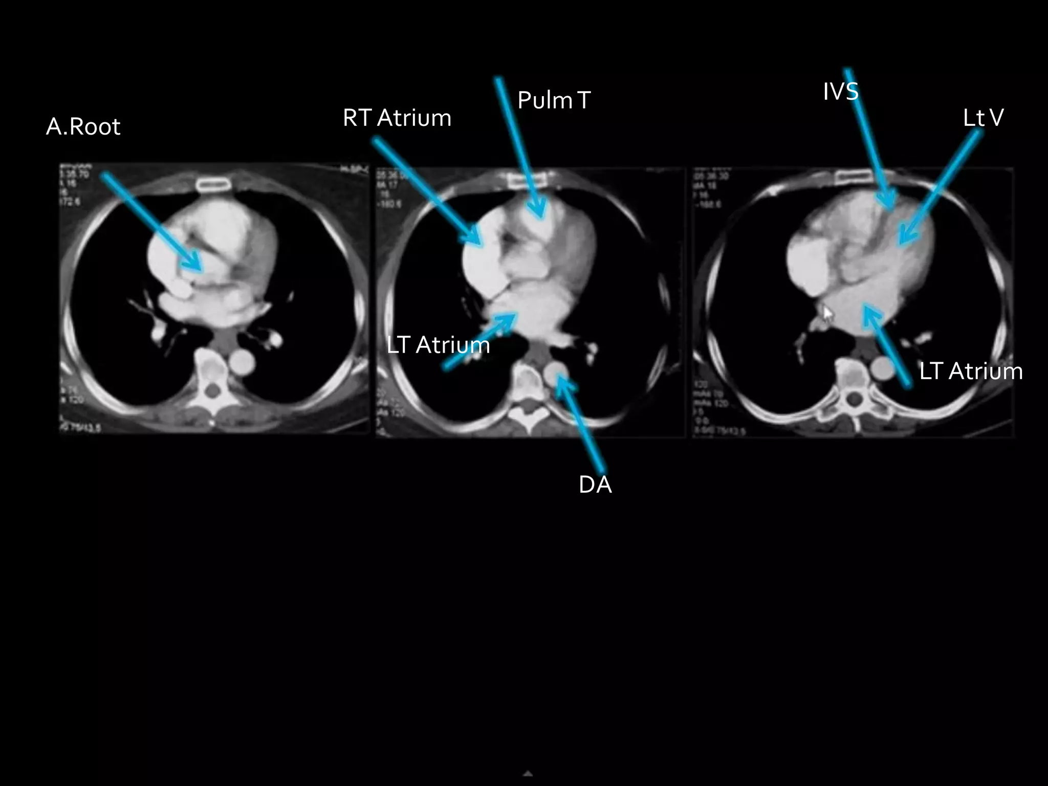 CT CHEST ANATOMY | PPTX