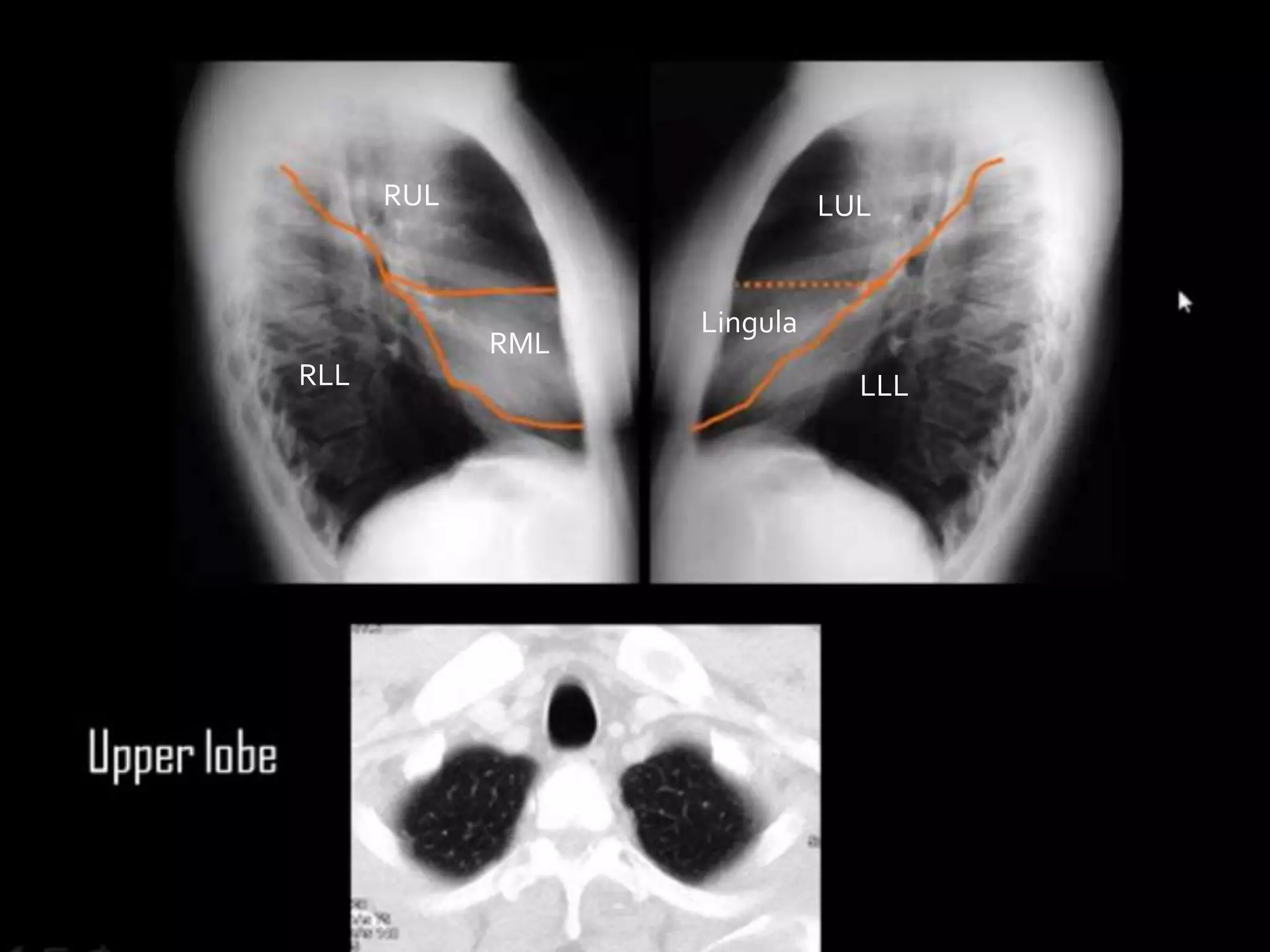 CT CHEST ANATOMY | PPTX