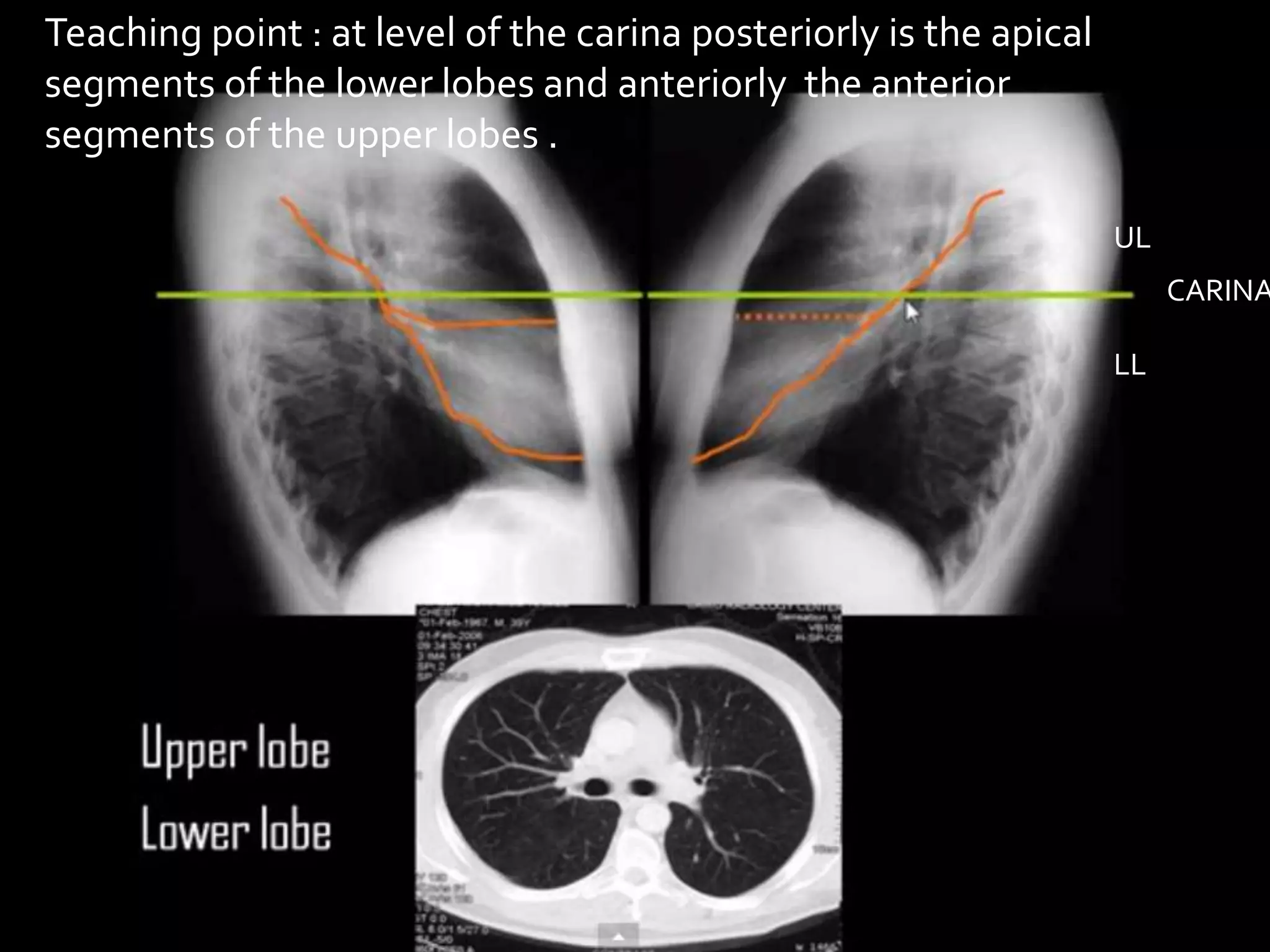 CT CHEST ANATOMY | PPTX
