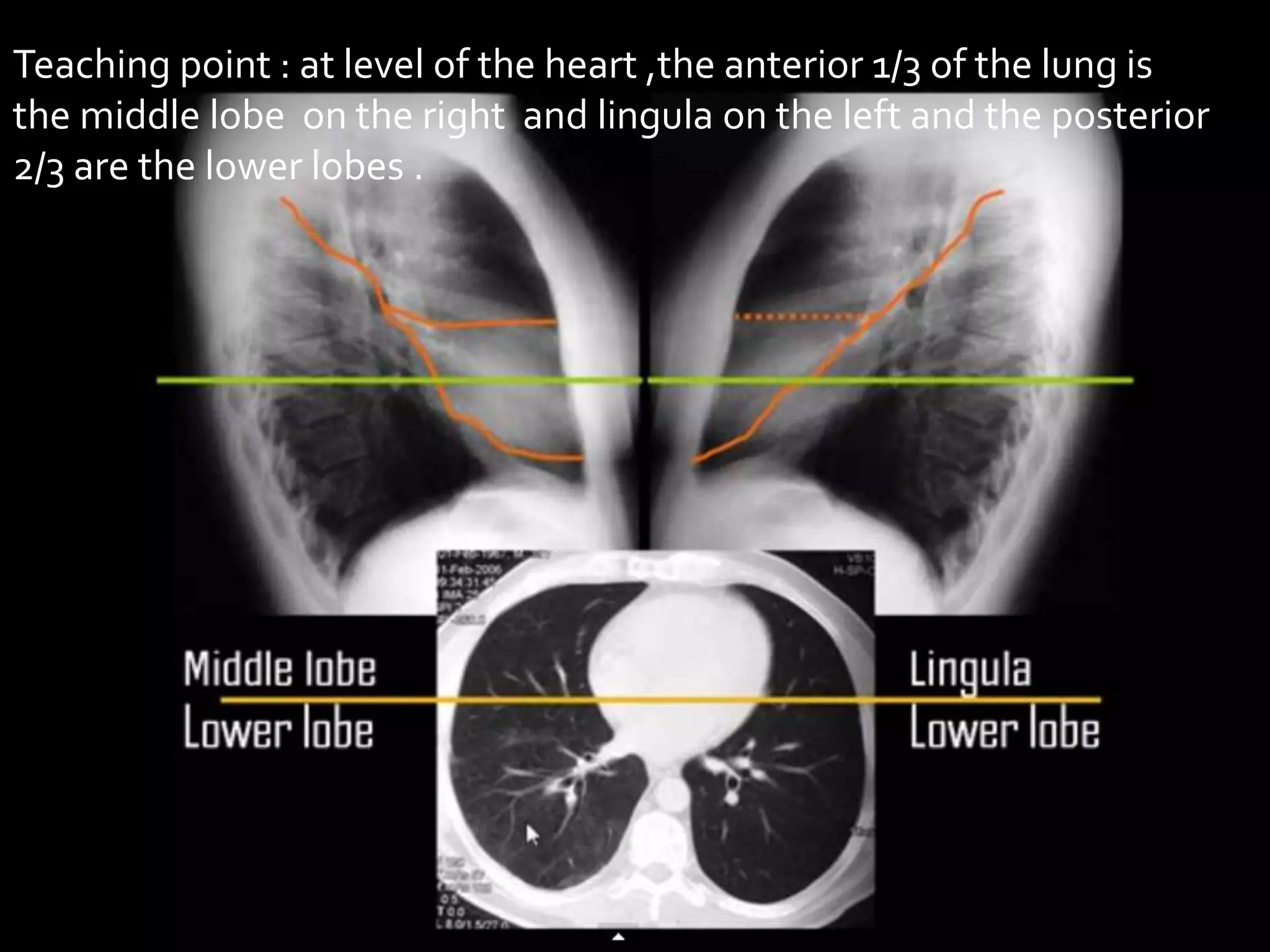 CT CHEST ANATOMY | PPTX
