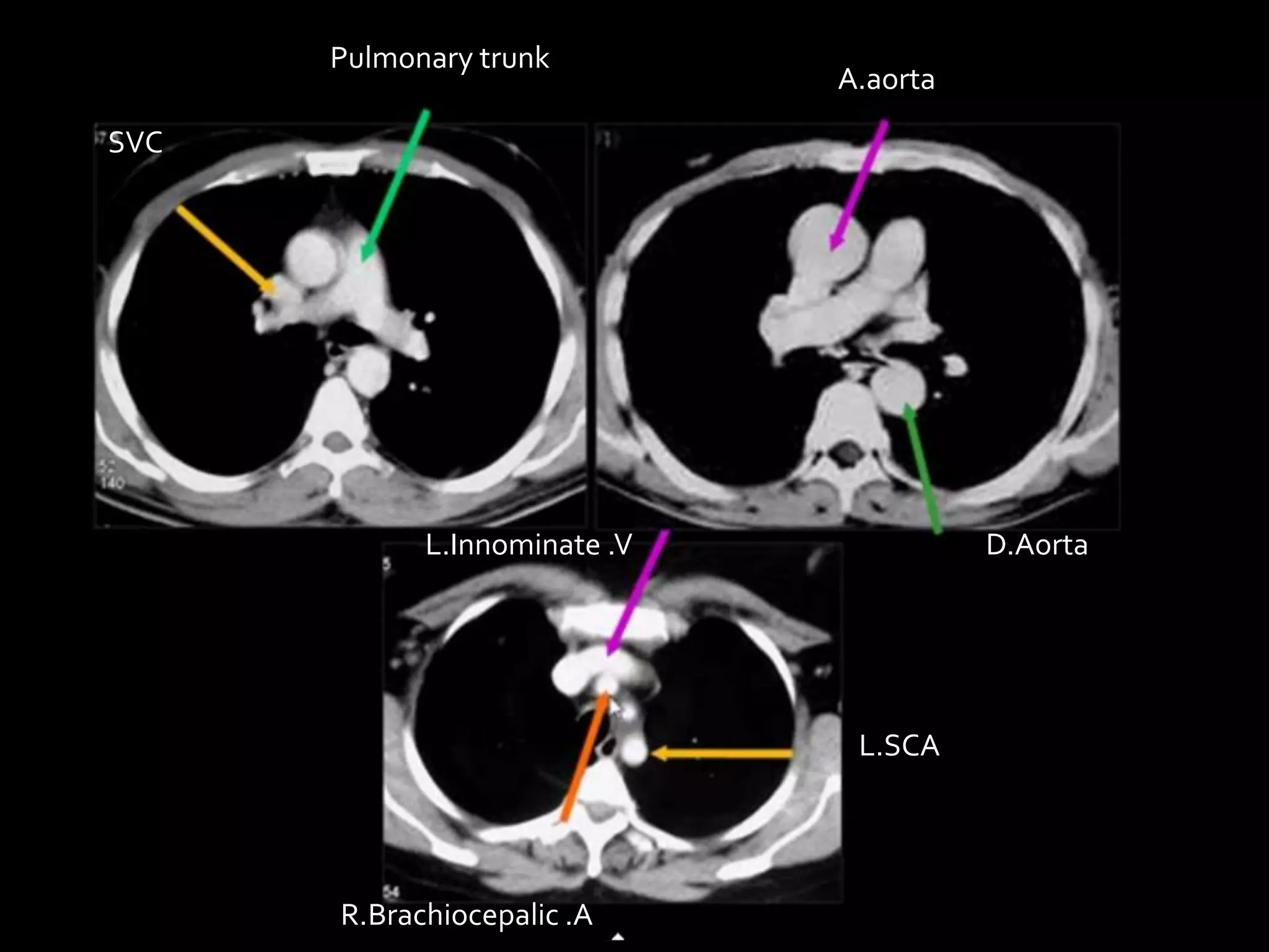 CT CHEST ANATOMY | PPTX