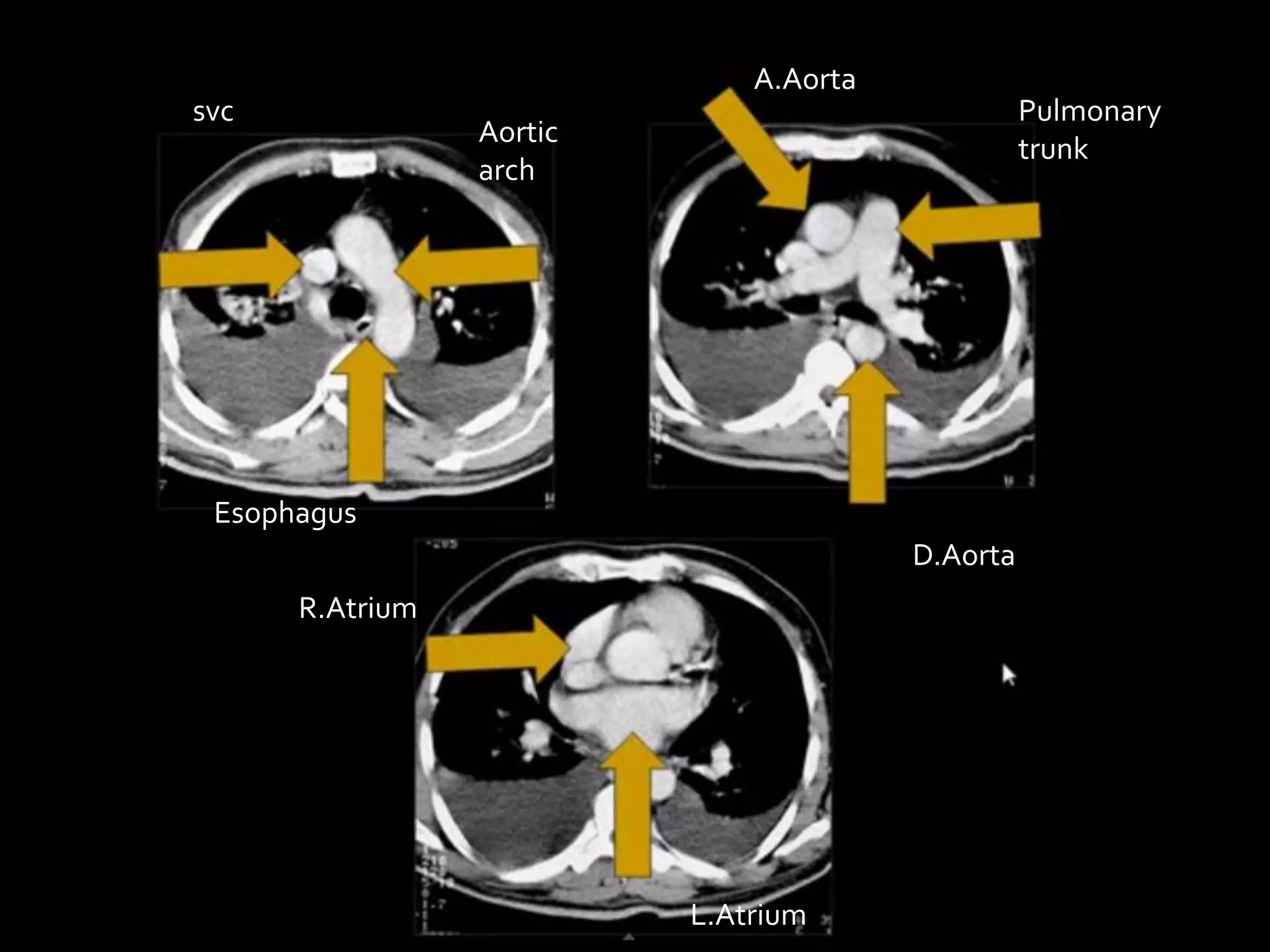 CT CHEST ANATOMY | PPTX